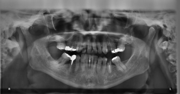 Le plombage dentaire : tout ce que vous devez savoir sur le sujet
